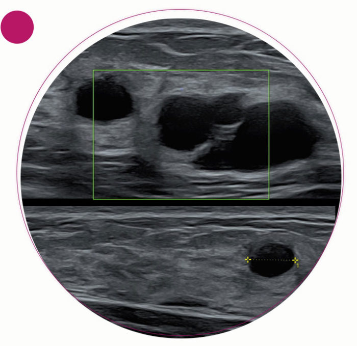 Mammasonografie DEGUM II